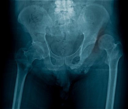 CS: Native Hip Dislocation | Orthorevision