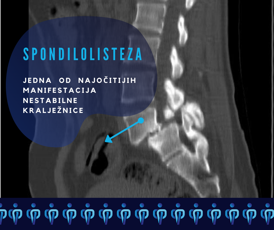 Spondilolisteza / Spondiloliza - znaci nestabilnosti kralježnice