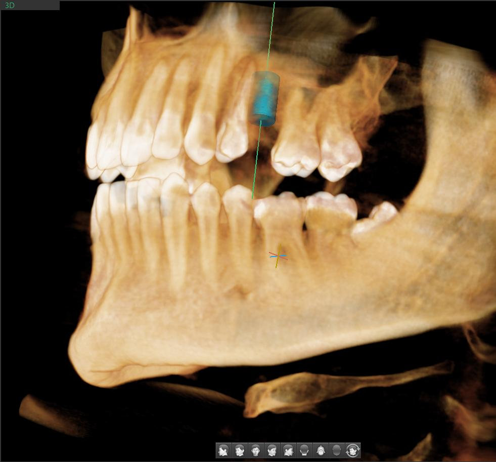 Dental Tomografi