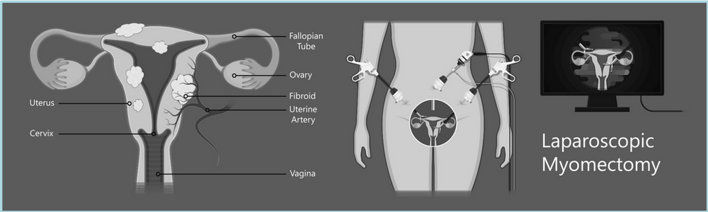Types of Myomectomy: Hysteroscopic, Laparoscopic, Abdominal