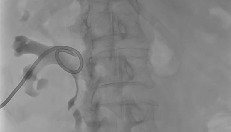 Percutaneous Nephrostomy for a Non-Dilated Collecting System | BackTable