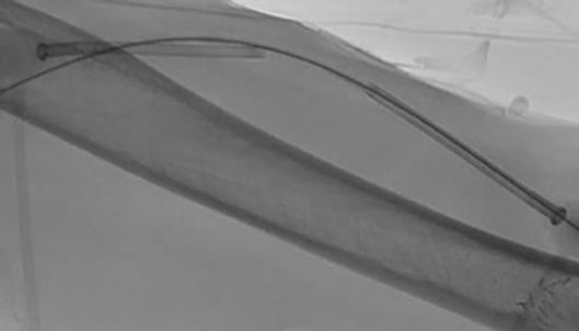 How to Declot AV Fistulas & Grafts: Finishing Touches & Follow-Up Care ...