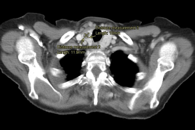 Thyroid Ablation: Expanding Treatment Options with Radiofrequency ...