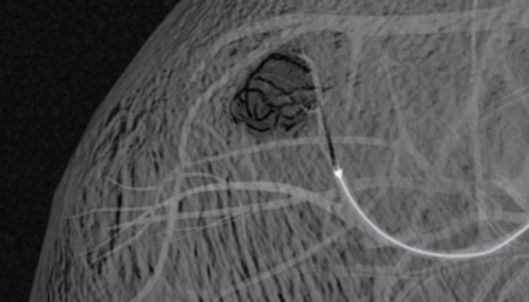 Principles of Pressure Directed Therapy with Y90 Radioembolization in ...