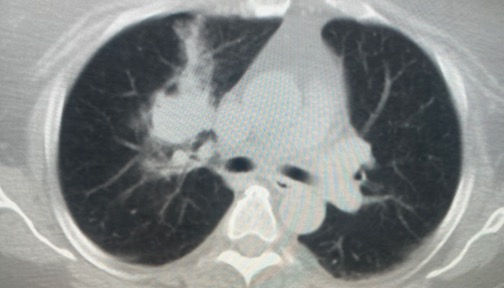 Pleural & Parenchymal Blood Patching Techniques in Lung Biopsy | BackTable