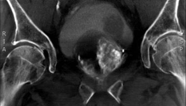 Imaging for Prostate Artery Embolization: CTA, Cone Beam CTA, or DSA ...