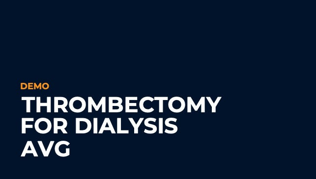 Thrombectomy of Dialysis AVG | BackTable Demo