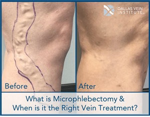 Microphlebectomy Vein Treatment | Dallas Vein Institute