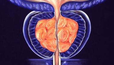 Prostate Artery Embolization Side Effects | BackTable