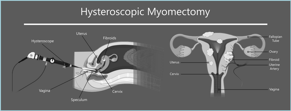 Types of Myomectomy: Hysteroscopic, Laparoscopic, Abdominal