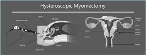 Types of Myomectomy - Hysteroscopic, Laparoscopic, Abdominal | Fibroid ...