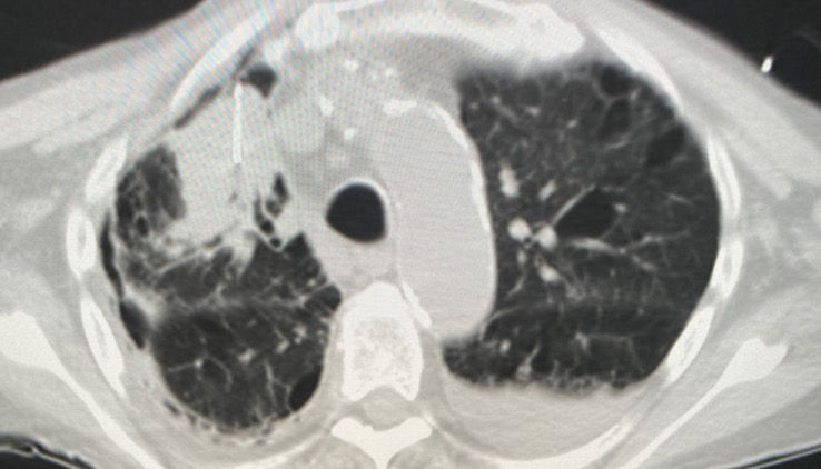 CT Guided Lung Biopsy Procedure Techniques | BackTable