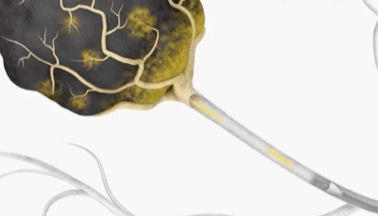 When To Use Pressure Directed Devices in Y90 Radioembolization