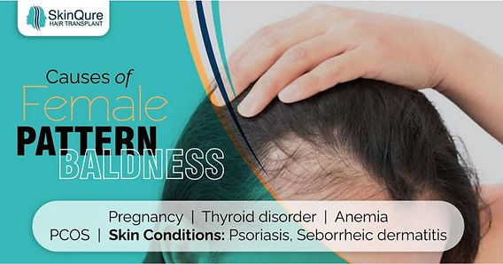 female pattern baldness cks