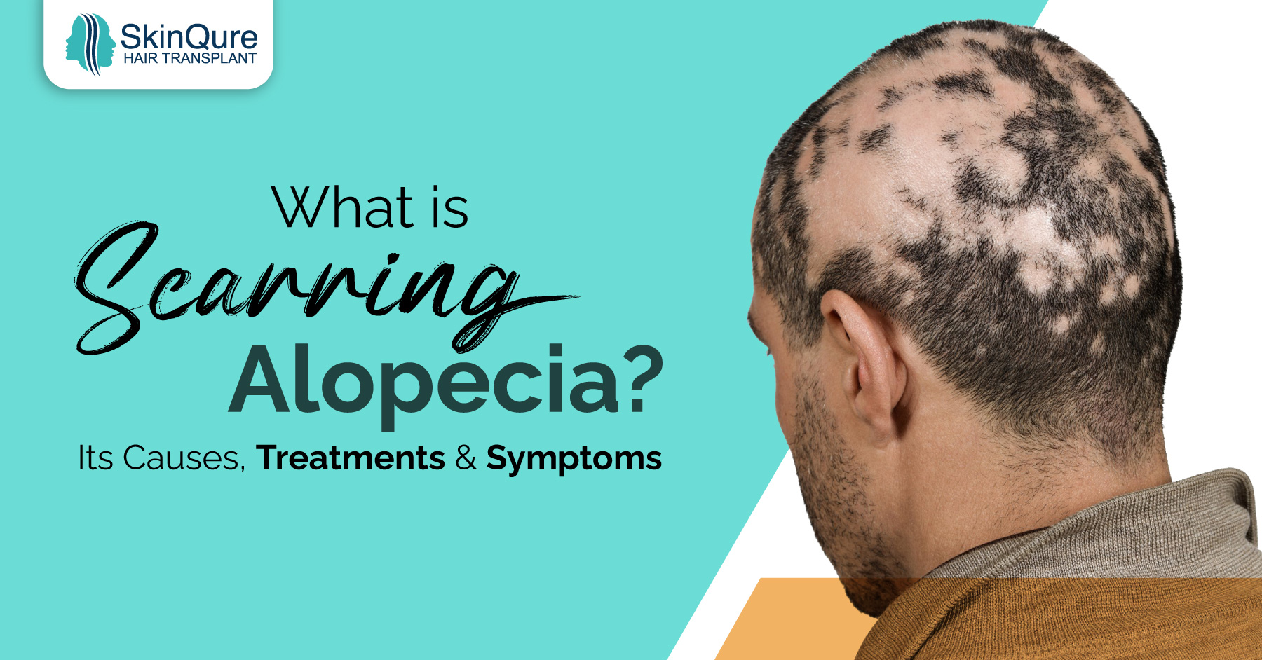 What Is Scarring Alopecia? Its Causes, Treatments & Symptoms