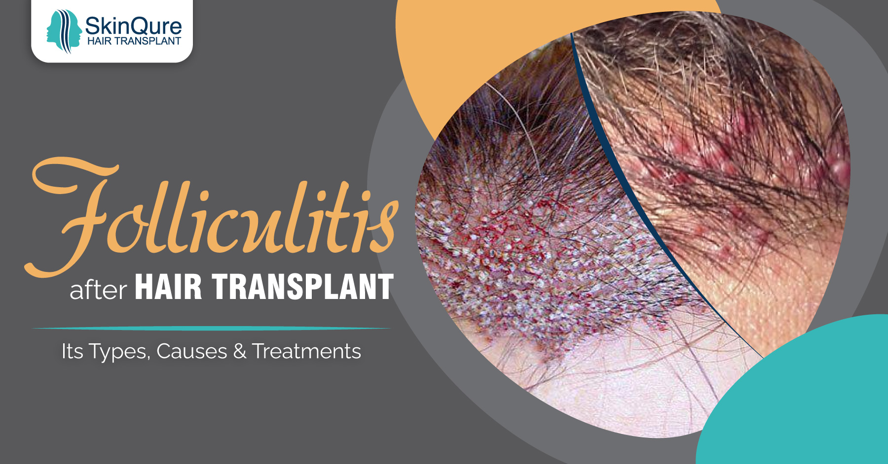 Folliculitis After Hair Transplant, Its Types, Causes & Treatments
