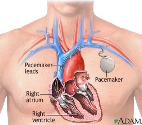 Pacemaker | Concord Cardiology
