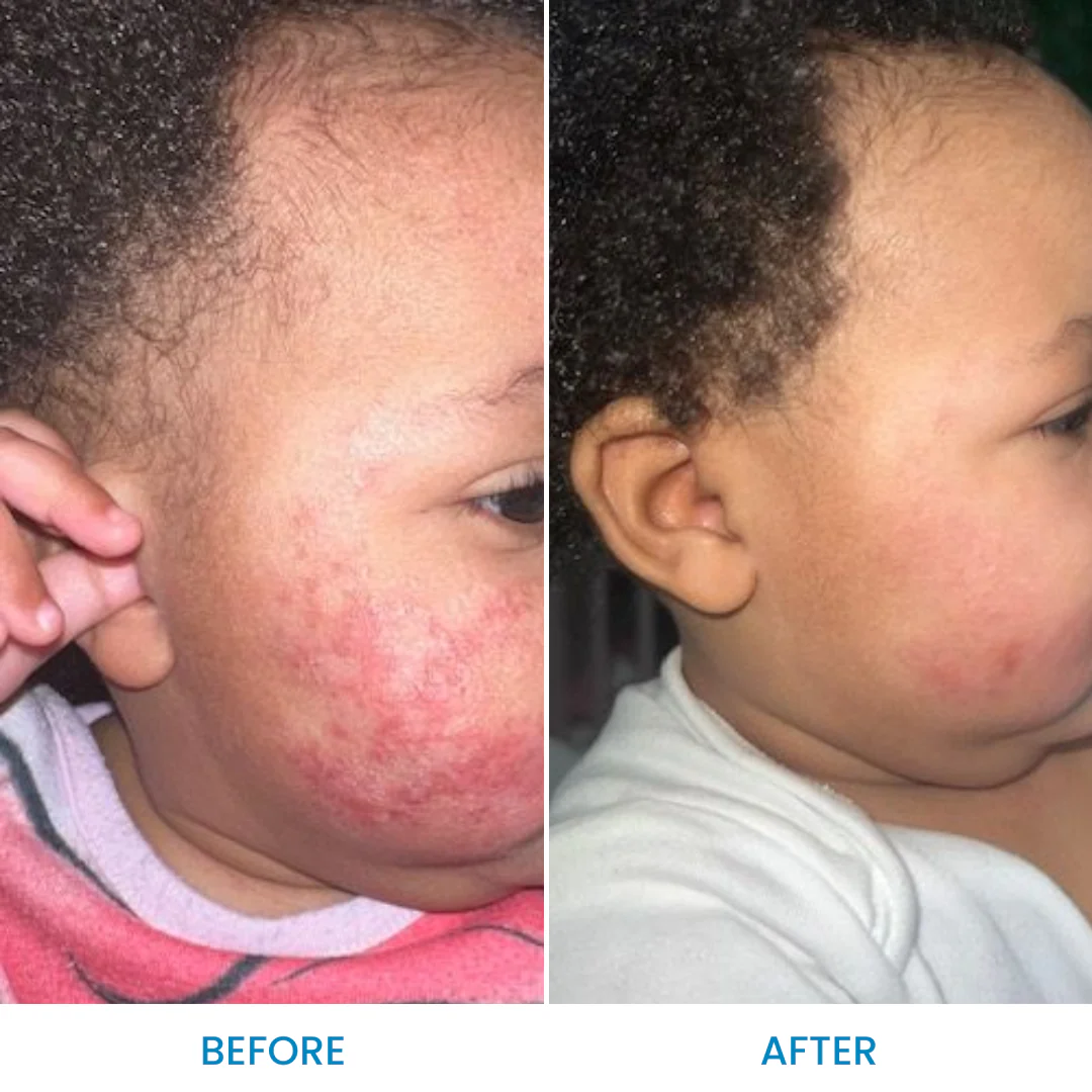 Natural Baby Eczema Cream | Balancebermuda