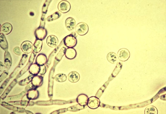 Candidíase Vaginal - Micose causada pela Cândida albicans.