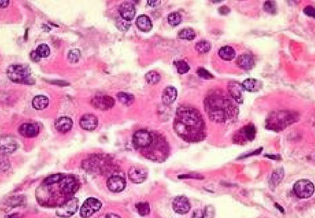 Glicogenose: Doença do armazenamento de glicogênio