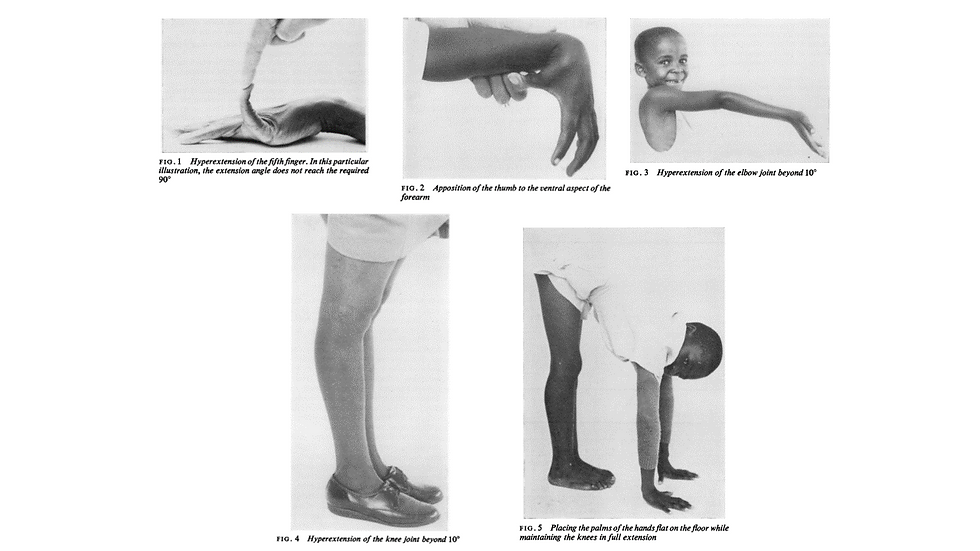Hypermobility: Beighton Score
