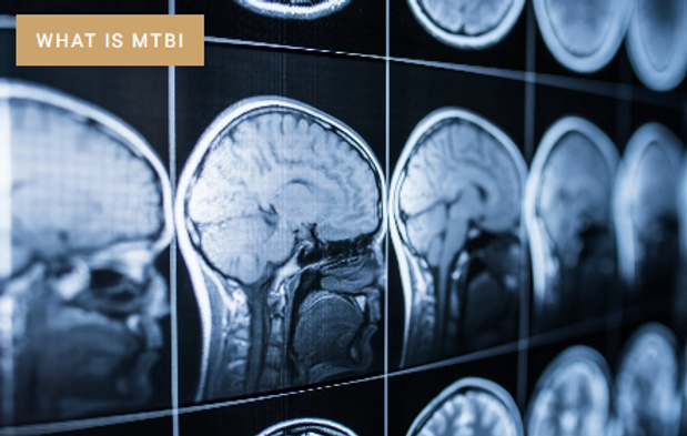 What is mTBI? A Comprehensive Guide
