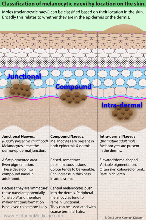 Benign Skin Lesions | tipsinplasticsurgery