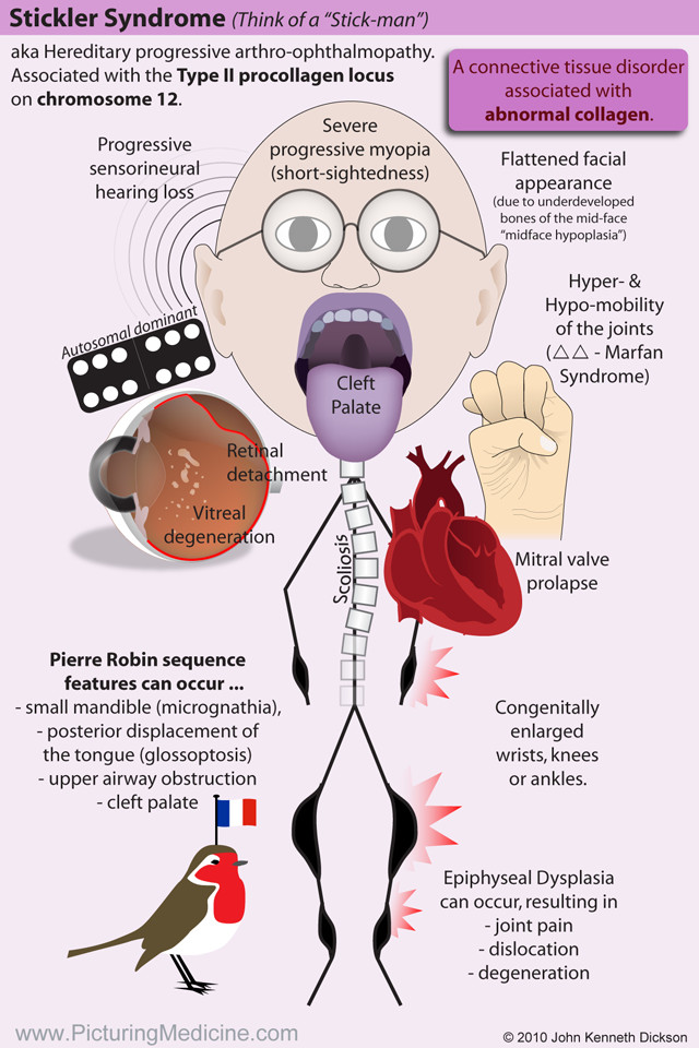 Stickler Syndrome Facial Features