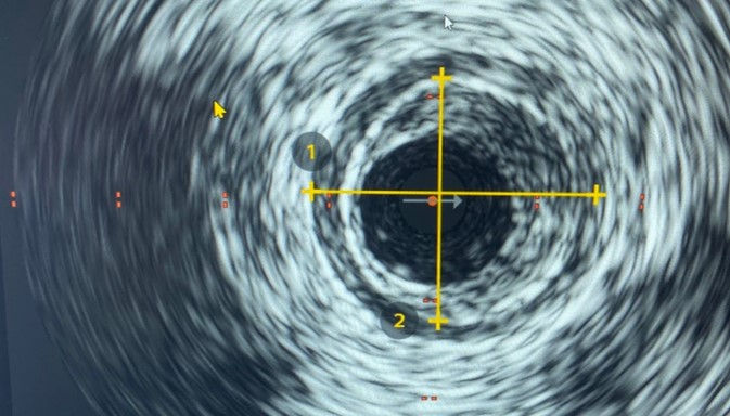 Using IVUS to Guide Treatment of Calcified Vessels with Intravascular ...