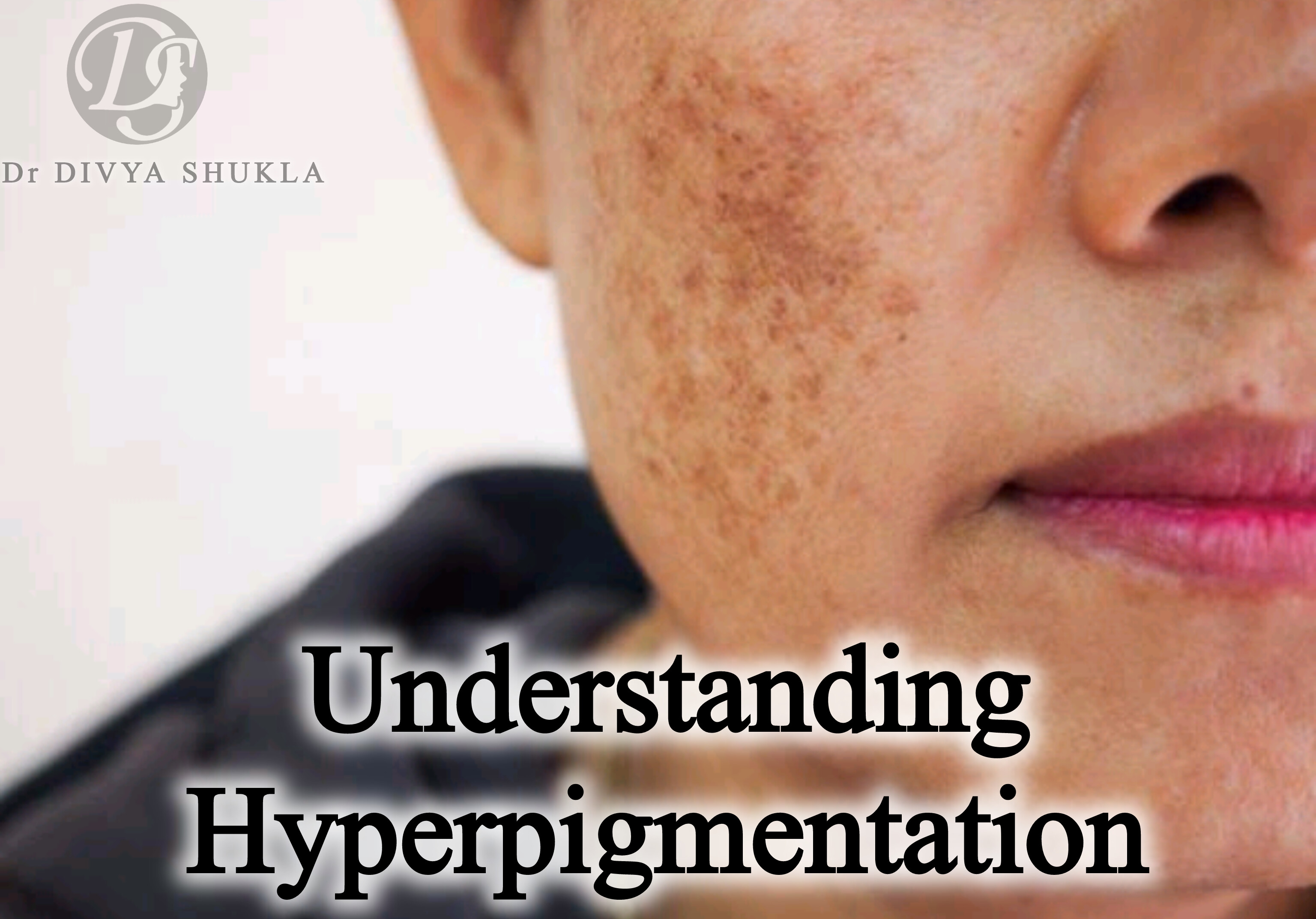 "Understanding Hyperpigmentation: Tips for Treatment and Prevention"