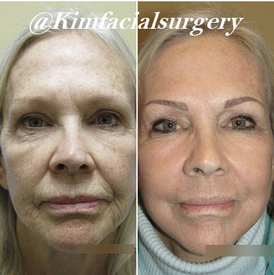 Kim Facial Plastic Surgery | Gallery - Autologous Fat Injection