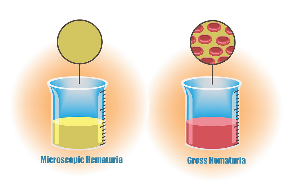 Red Urine as a Red Flag for Kidney Cancer