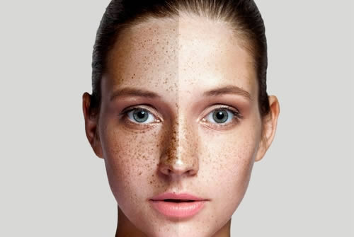 'Melasma is a common skin condition characterized by brown or grayish ...
