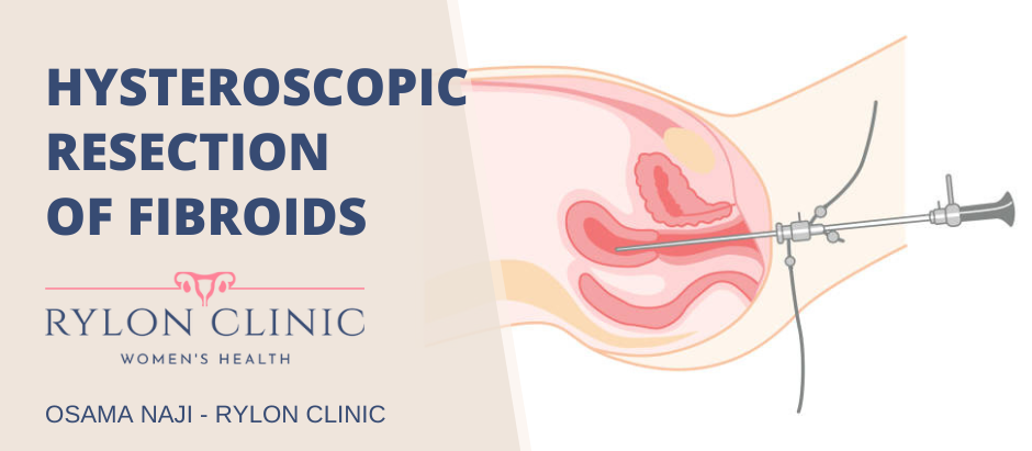 hysteroscopy fibroid removal