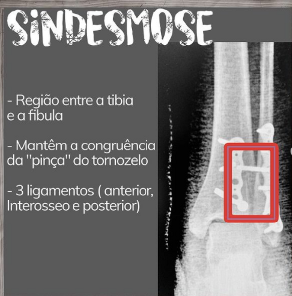 SINDESMOSE ("pinça" articular )