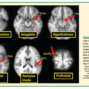 Postural Orthostatic Tachycardia Syndrome (POTS) | Chiari Fund