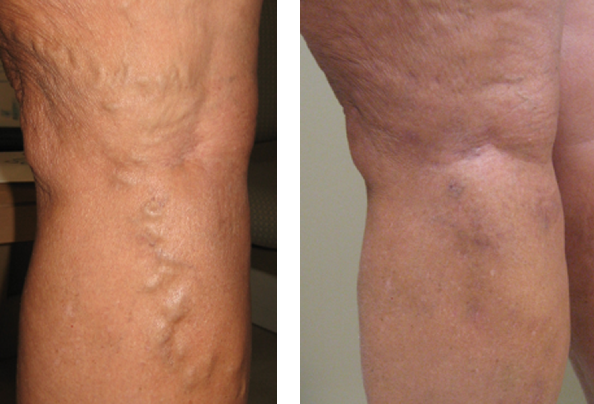 Vein Disease & Varicose Vein Treatment | Evansville, IN Owensboro, KY