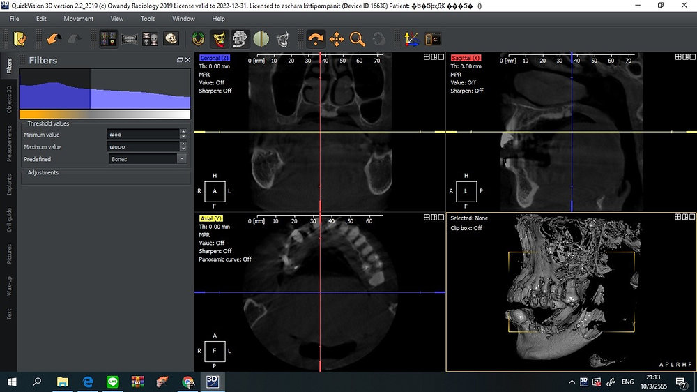 How important of the 3D dental x-ray on implant treatment?