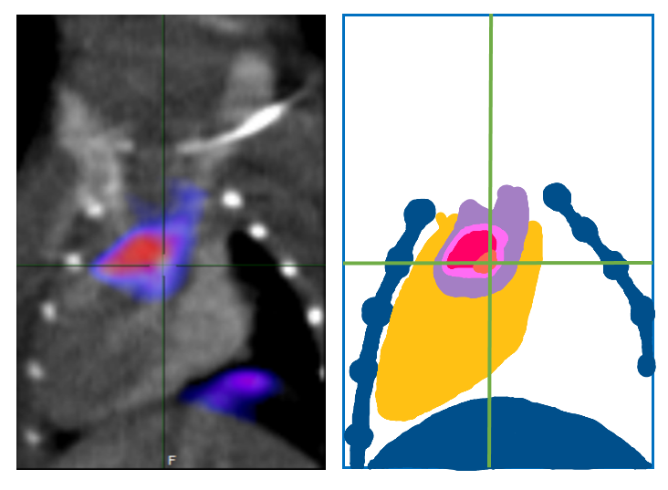 Studying mice to help prevent heart attacks and stroke