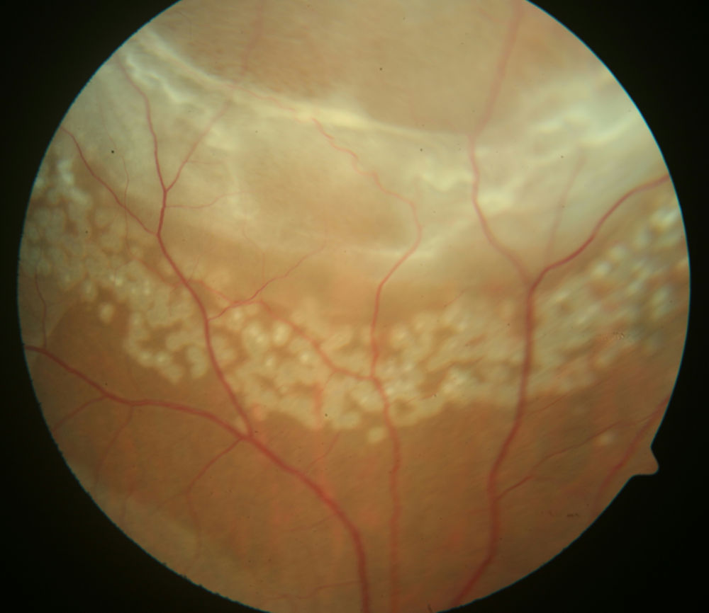 Eye Floaters & Retinal Detachment