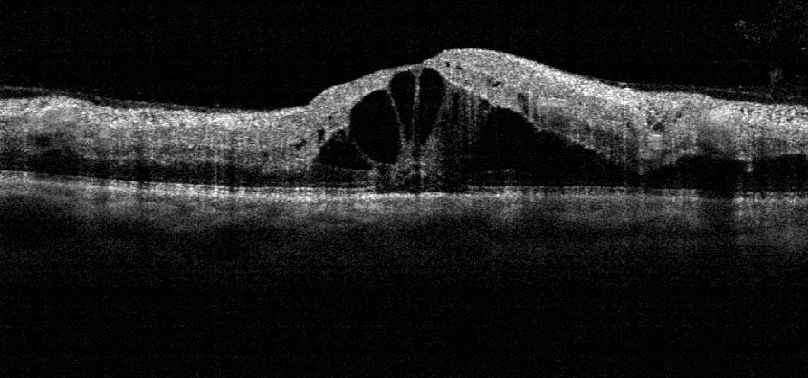 Diabetic Retinopathy