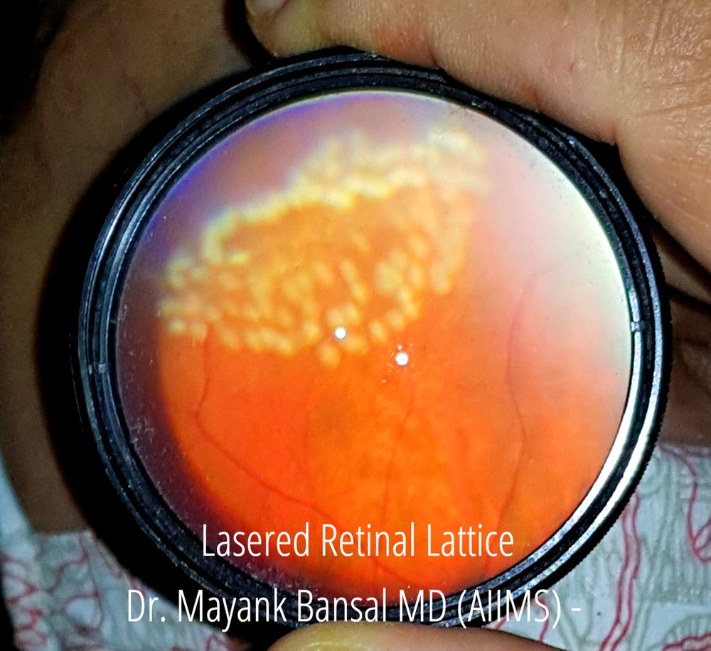 Eye Floaters & Retinal Detachment