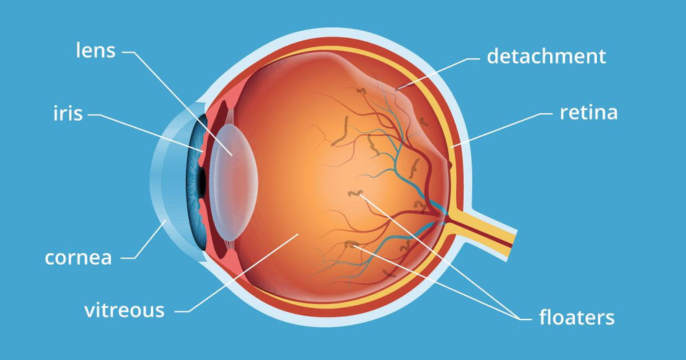 Eye Floaters & Retinal Detachment