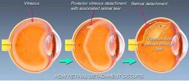 Eye Floaters & Retinal Detachment