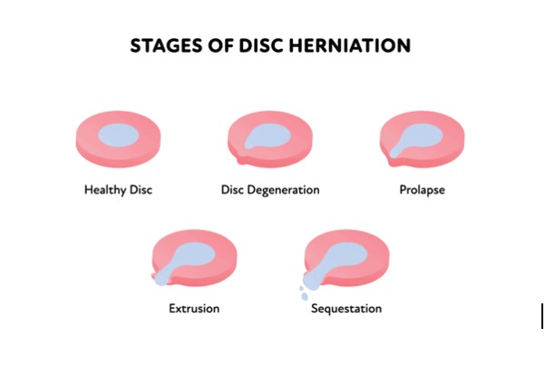 Myth Busting the “Slipped Disc”https://static.wixstatic.com/media ...