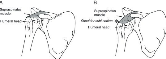 Shoulder instability: What is it and can physio help?