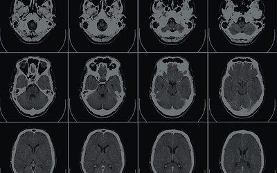 Medical | Neurocle Inc.