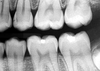 The Importance of Dental X-Rays and Why We Recommend Them