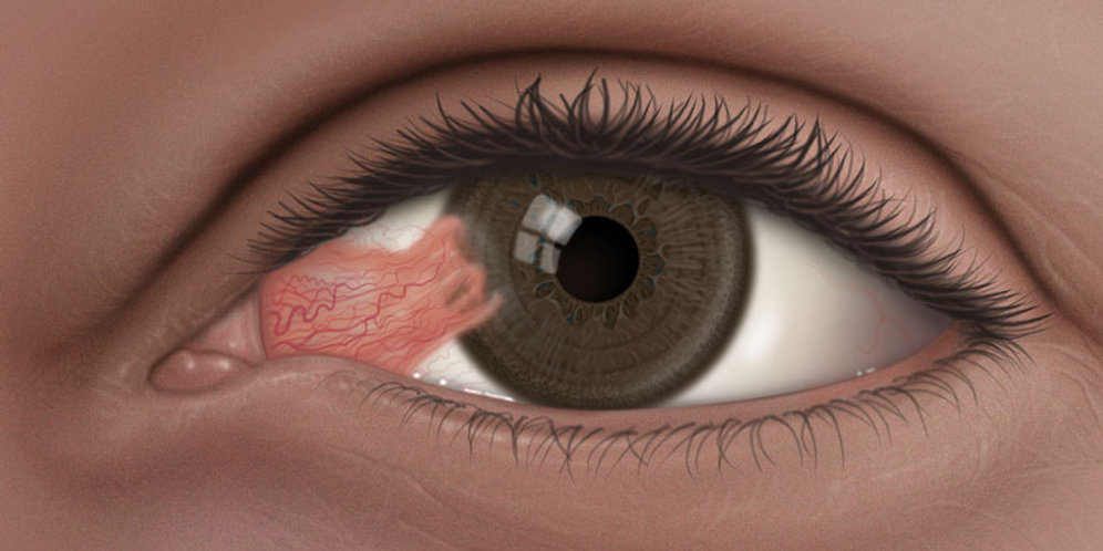Eye pterygium- Should I prevent it or treat it? How to prevent it.