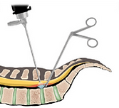 Endoscopic Spinal Surgery | Maars Medical